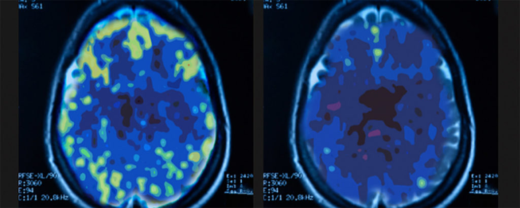 Transcranial Magnetic Stimulation in Albuquerque | SageClinic.org